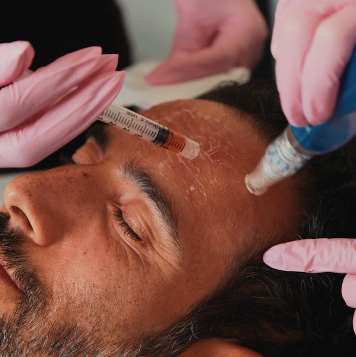 Microneedling with PRF Carmichael Dr. Almonte Facial Plastic Surgery